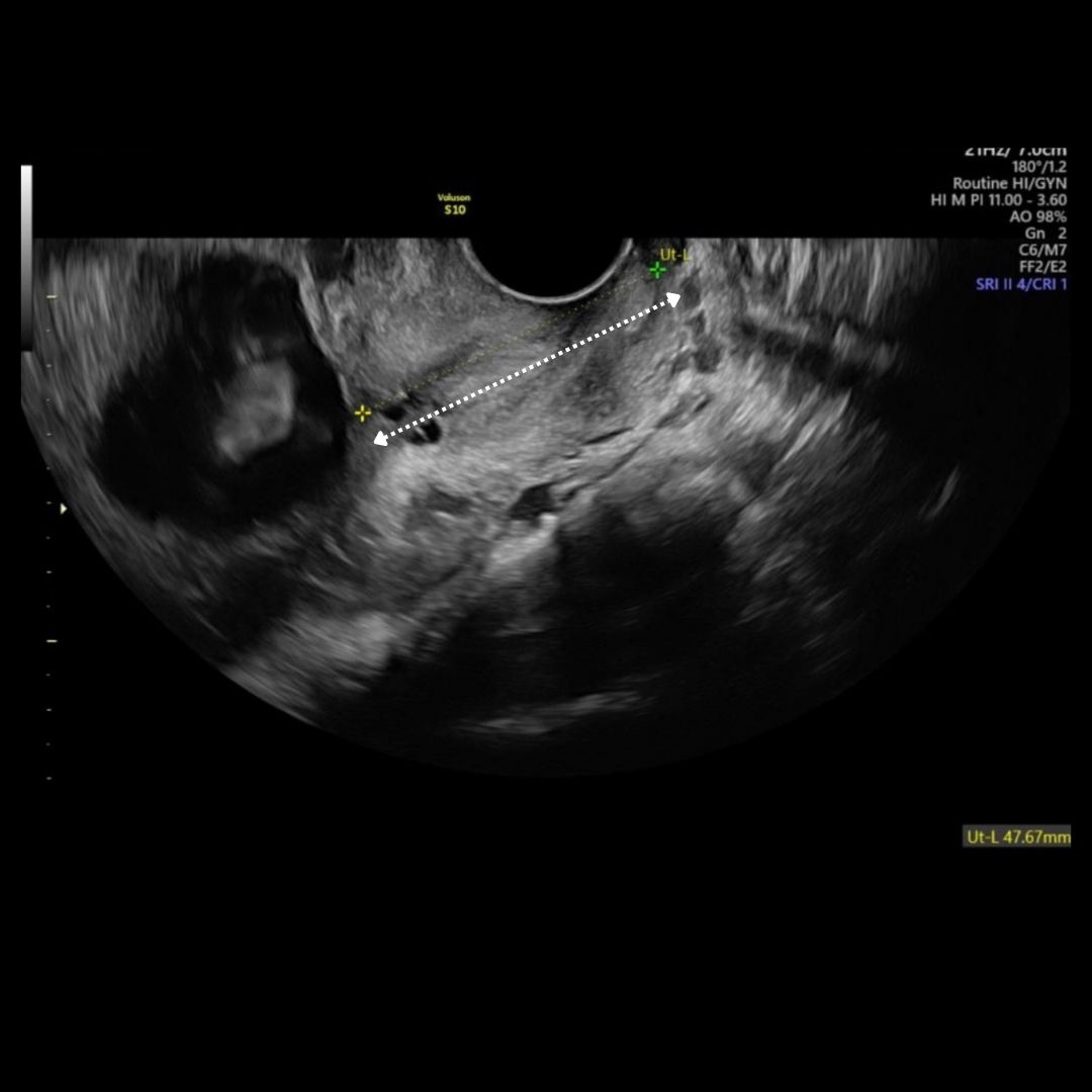 ¿Por qué es importante la ecografía de las 20 semanas?